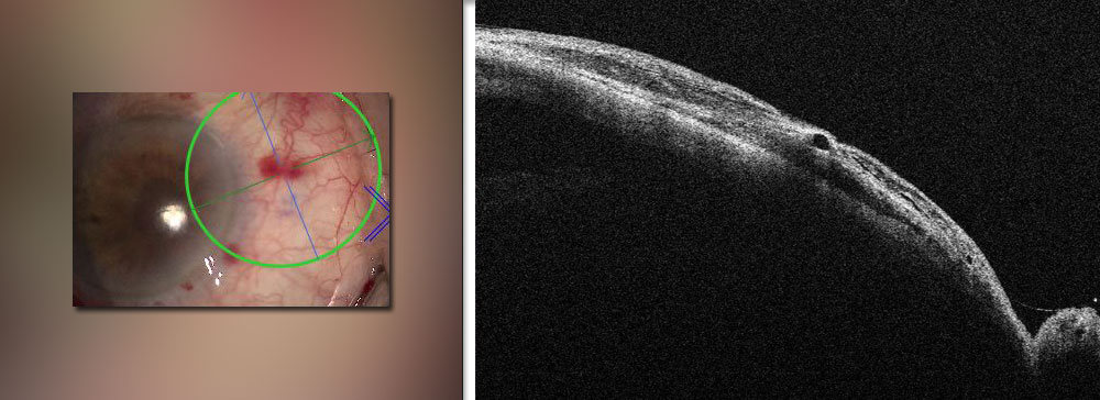 glaucoma-surgery-2_01